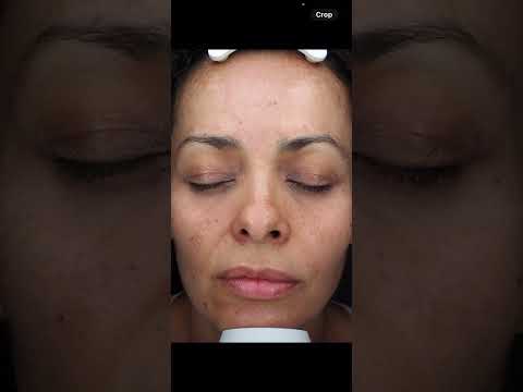 A Possible Cure for Melasma