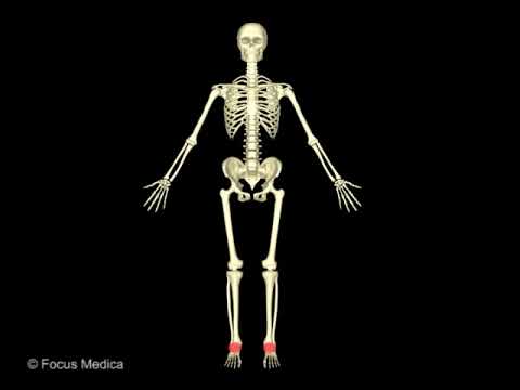 Arthroscopic synovectomy - Rheumatology