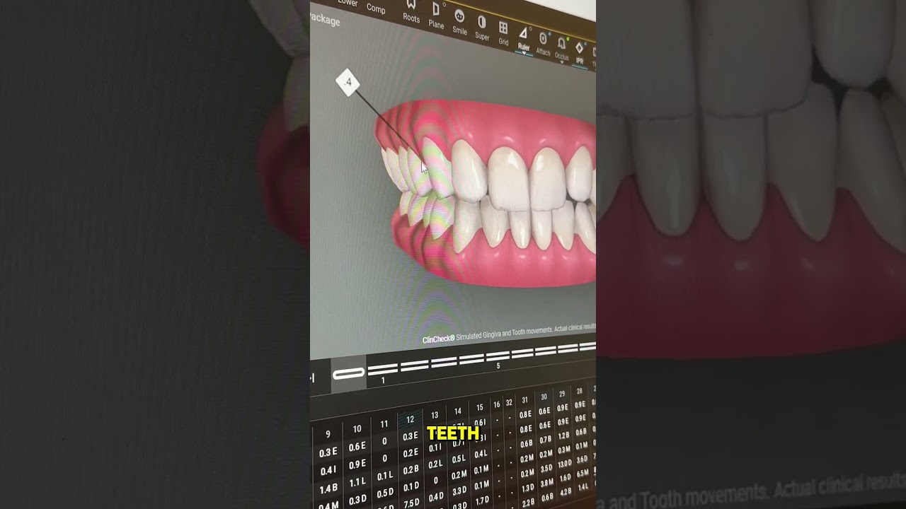 Invisalign Fixes Crowding & Bite Issues | Gentle Dentistry Poway