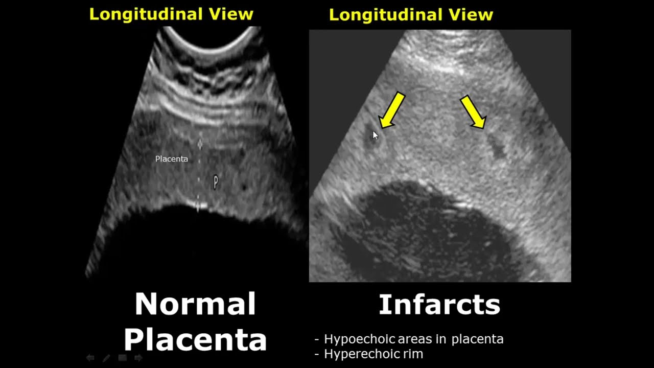 Placenta Ultrasound Normal Vs Abnormal Image Appearances Comparison | Placental Pathologies on USG