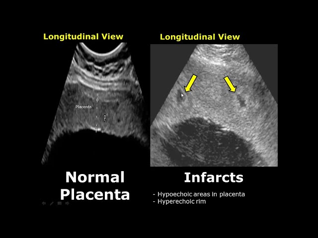 Understanding Placenta Ultrasound: Normal vs Abnormal Appearances ...