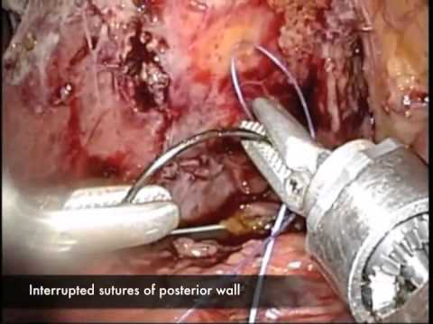 Reduced port surgery for choledocho-jejunostomy using manual manipulators