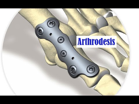 Arthrodesis CPT codes - simplify medical coding