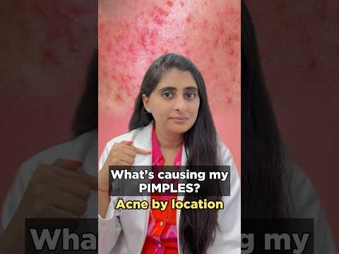 Pimples on face | How to treat acne and pimples on face | What acne means | Dermatologist
