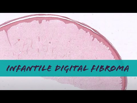 Infantile digital fibroma (inclusion body fibromatosis) pathology dermatology dermpath