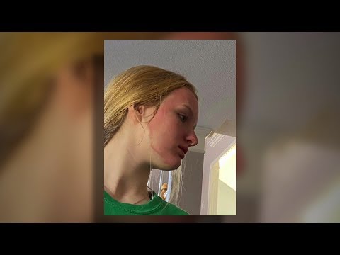 'If it's Tingling--it's Working': Missouri Teen Says Popular Face Mask Burned Her Skin