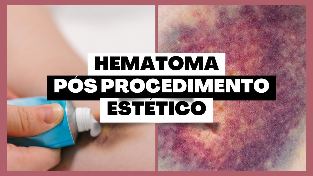 HEMATOMA pós procedimento estético? Saiba como tirar MANCHAS ROXAS da pele