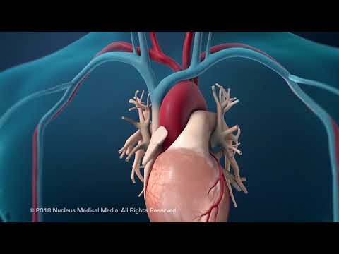Coronary Artery Angioplasty (Radial Access) - Hindi