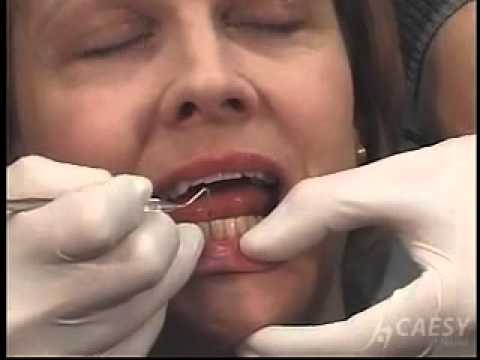 Premier Dental: Gingivitis-Family Dentist Bellevue NE