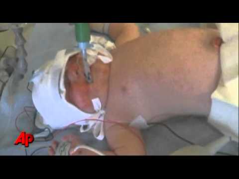 Doctors Cool Newborn to Limit Brain Damage