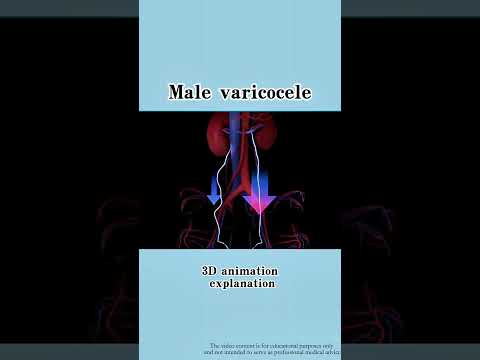 In the Spotlight:Male Varicocele Simplified!#menshealth #dryiyimenshealth #varicocele #healthfacts