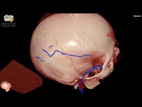 Stanford Neurosurgery Virtual Reality Lab's Anatomy in 3D: MRA and MRV aneurysm