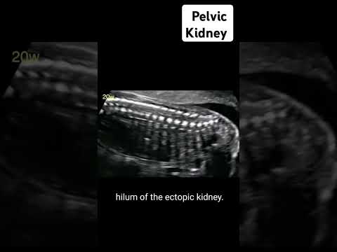 Fetal pelvic kidney on ultrasound #radiology #ultrasound #pregnant #pregnancyscan #baby
