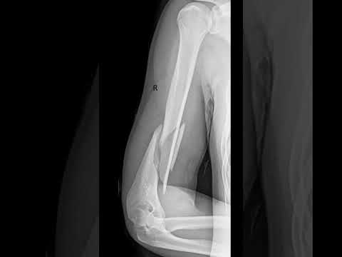 Extra-articular spiral fracture of the distal third of the humerus with lateral displacement #shoet