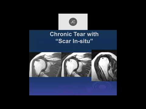 MR of the Rotator Cuff | 2023, Part 3