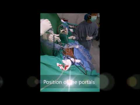 Video-Assisted Thoracoscopic Surgery for Drainage of Dorsal Paravertebral Abscess