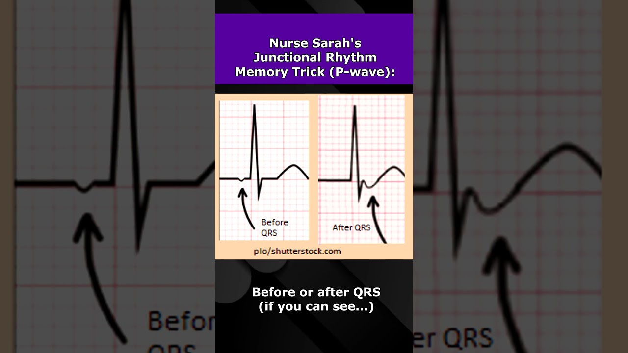 Junctional Rhythms ECG Nursing Mnemonic NCLEX EKG Review
