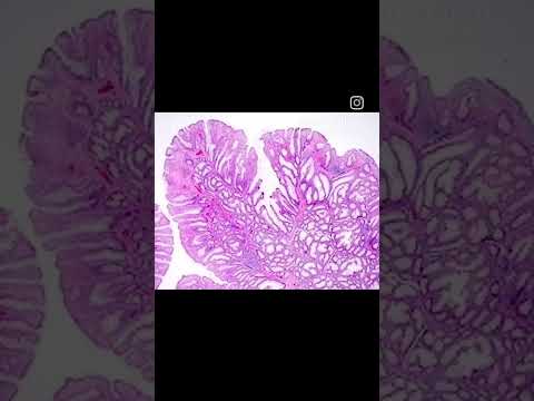 Type of Hamartomatous polyp .Comment most common site of polyp ??