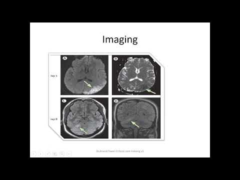 status epilepticus -An update