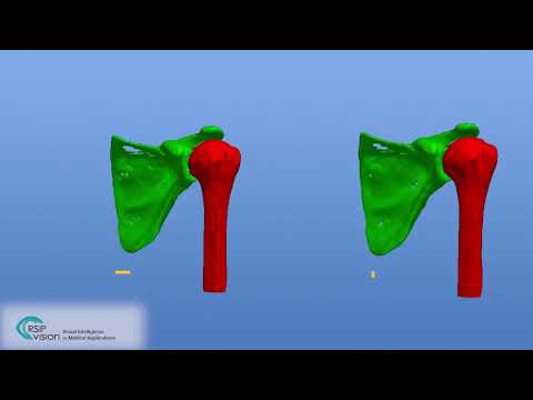 Total Shoulder Arthroplasty planning from MRI by RSIP Vision