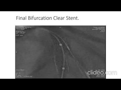 Clear Stent Live
