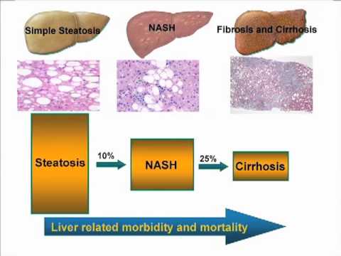 Liver Update - Ep. 3 - Fatty Liver Disease, Alcoholic Liver Disease, and Cholestatis