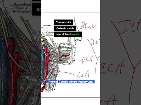 Internal Carotid Artery Aneurysm Explained