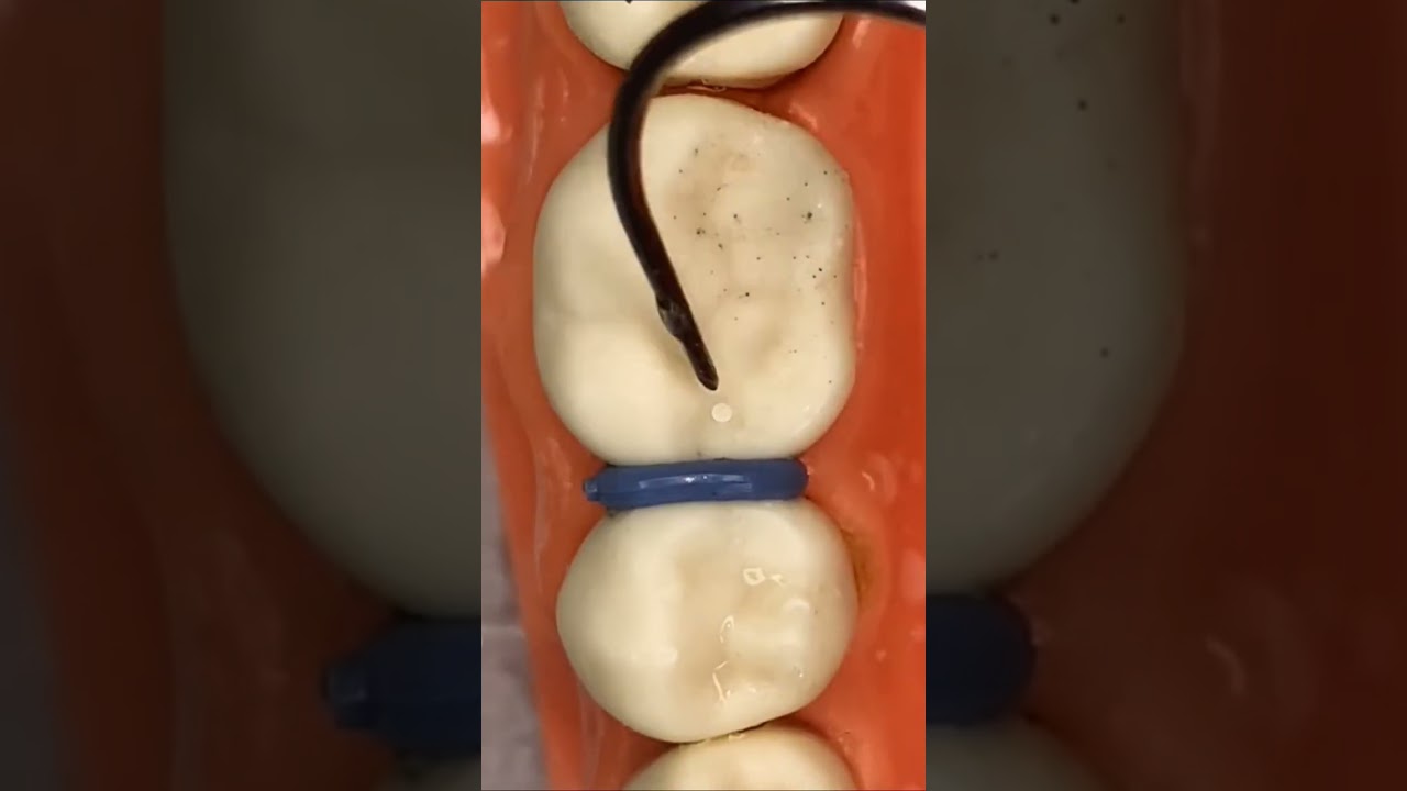 wow amazing 😱😱😱😱😱 #teeth #teethdecay #braces