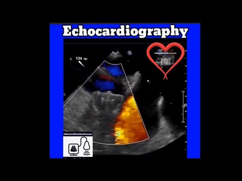 Watchman Procedure