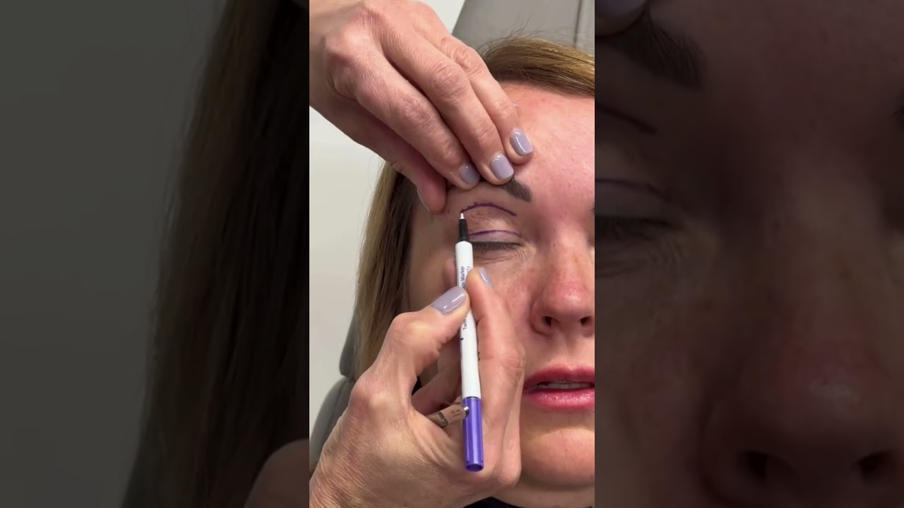 Upper Blepharoplasty Pre-Op with Dr. Schrader
