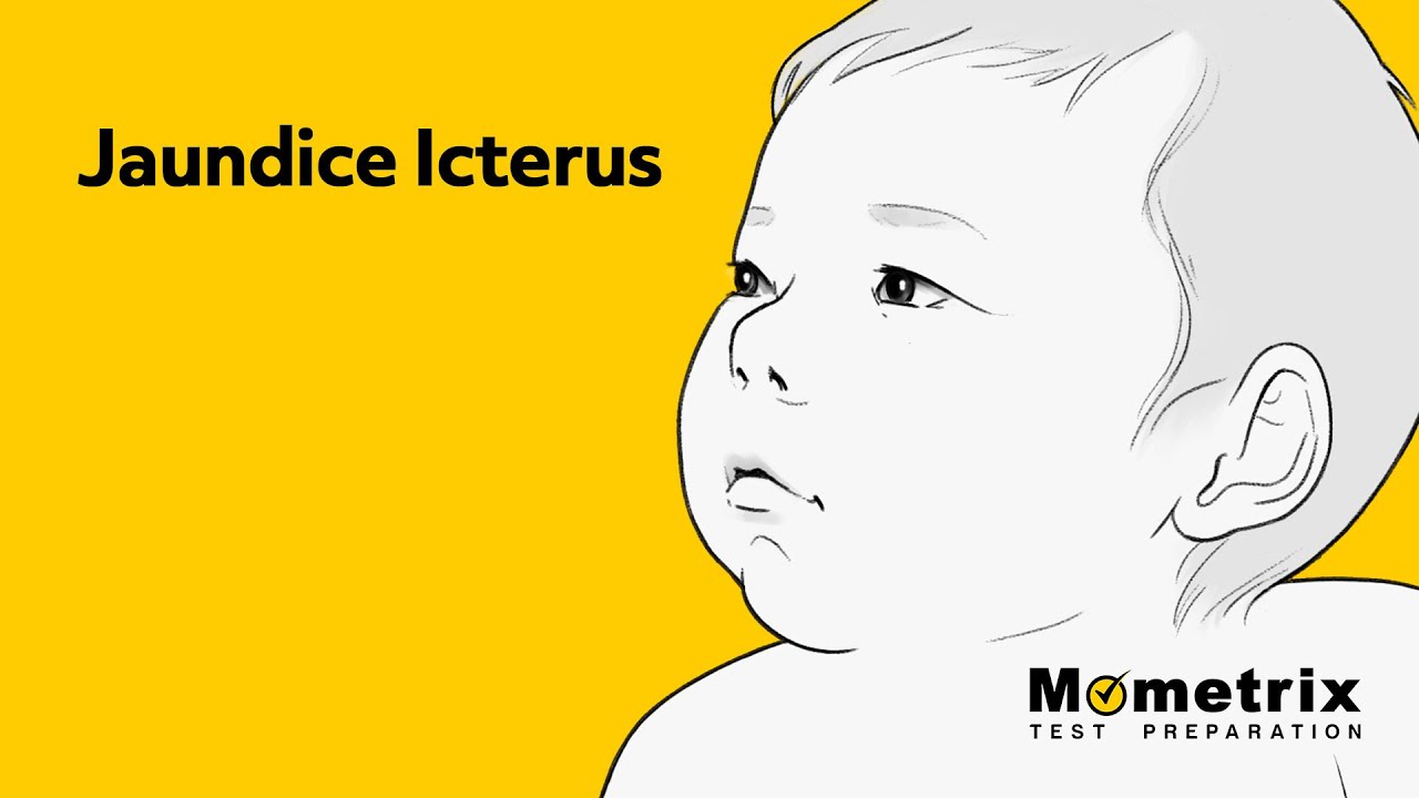 Jaundice Icterus