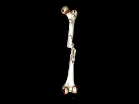 comminuted fractrure of the mid diaphysis of the femur with posterior displacement #ctscan #3d