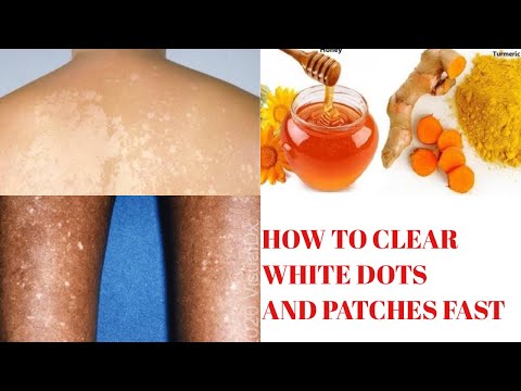 HOW TO CLEAR WHITE PATCHES AND DOTS VERY FAST/CLEAR BLEACHING PATCHES IN ONE WEEK