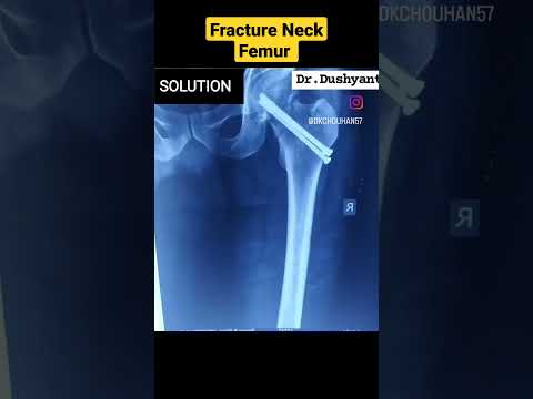 Neck Femur Fracture | Problem Vs Solution | #femur #fracture