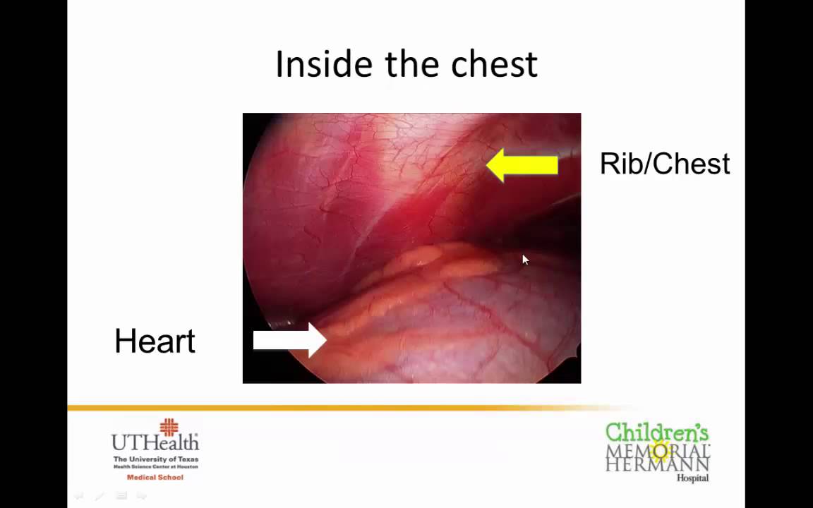 Pediatric Chest Deformities   Pectus   Webinar