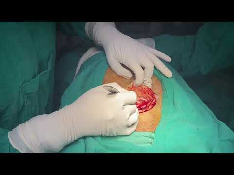 Pfannensteil incision for cesarean section