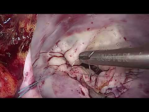 Video case presentation by Prof. Jörg Kempfert from the German Heart Center Charite
