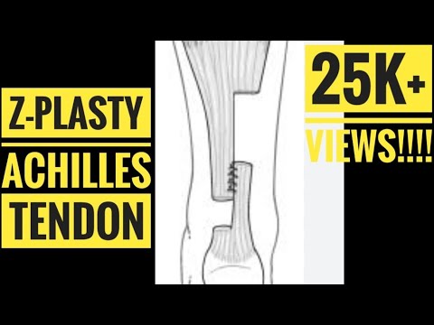 Z-Plasty of Achilles Tendon (Achilles Tendon Lengthening)