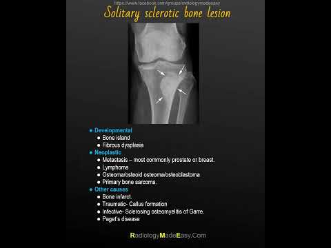 Differential diagnosis for Solitary sclerotic bone lesions?