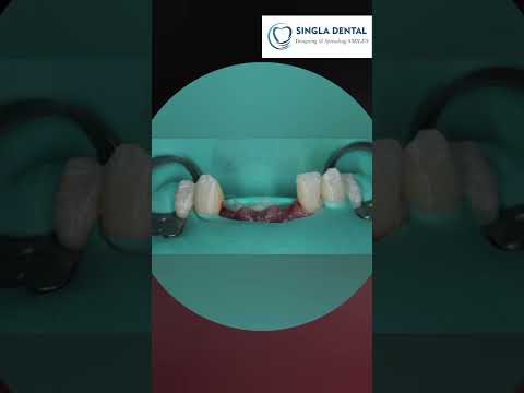 Reimplantation of avulsed tooth #viralshorts #trendingshorts #dentist