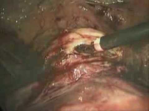 Total Laproscopic Hysterecrtomy-Dr. Charles Koh
