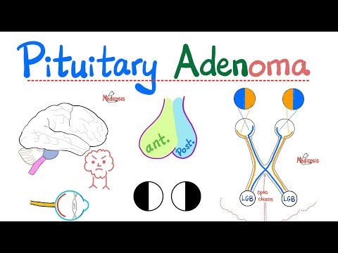 Pituitary Adenoma - Pituitary Tumors - Prolactinoma - Microadenoma, Macroadenoma - Visual Field