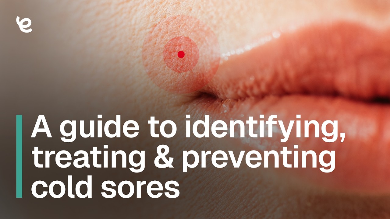 A Guide to Identifying, Treating, and Preventing Cold Sores