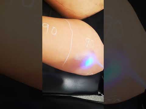 Cryosculpting (fat freezing) thighs and bum
