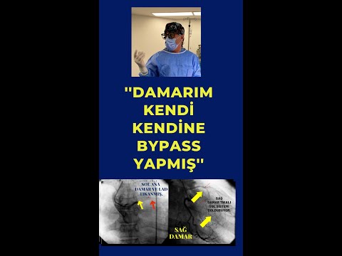 Sağlık, Damarım kendi kendine bypass yapmış, Serdar Akgün, Bypass Doktor