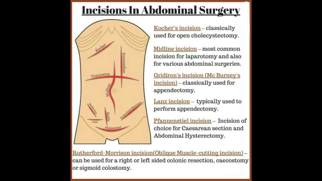 Incisions in abdominal surgery#humananatomy#shortsvideoedit#edit#viral#nclexnursing#mbbsstudent#gnm#