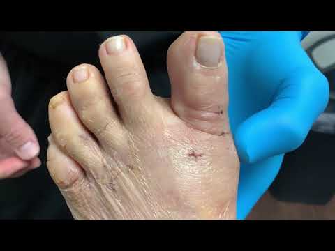 DAY 13 AFTER MINIMALLY INVASIVE BUNION & HAMMERTOE SURGERY (Before and After Pictures) πππ