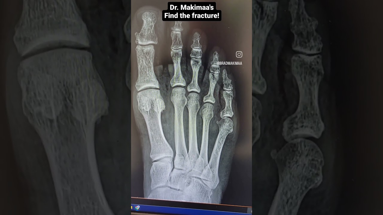 Find the fracture- second metatarsal base fracture