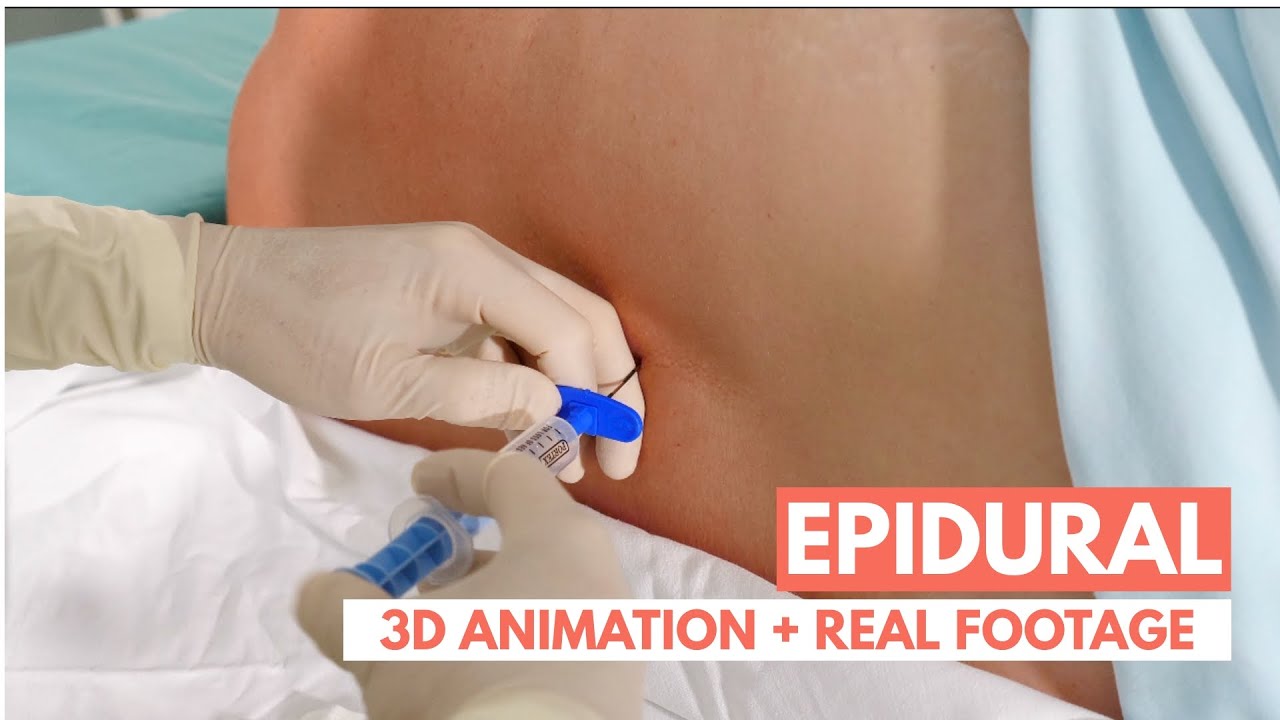 Epidural Anesthesia | 3D Animation + Real Footage