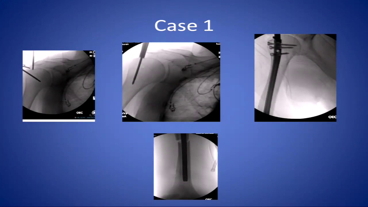 Humerus fractures - Panel discussion